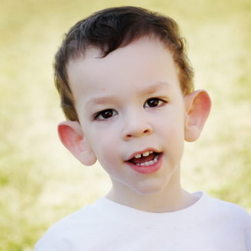 Signs and symptoms of Fragile X Syndrome | Autistic Advisor
